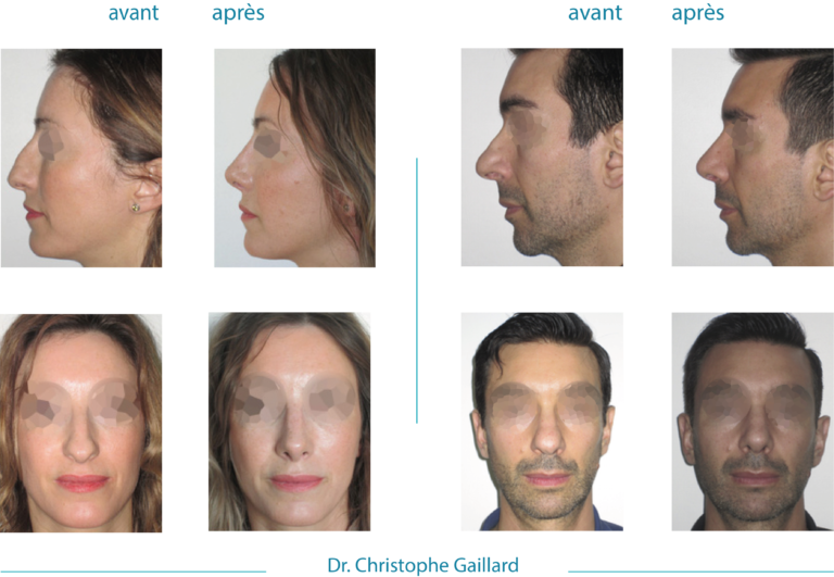 Avant/après - Rhinoplastie Paris