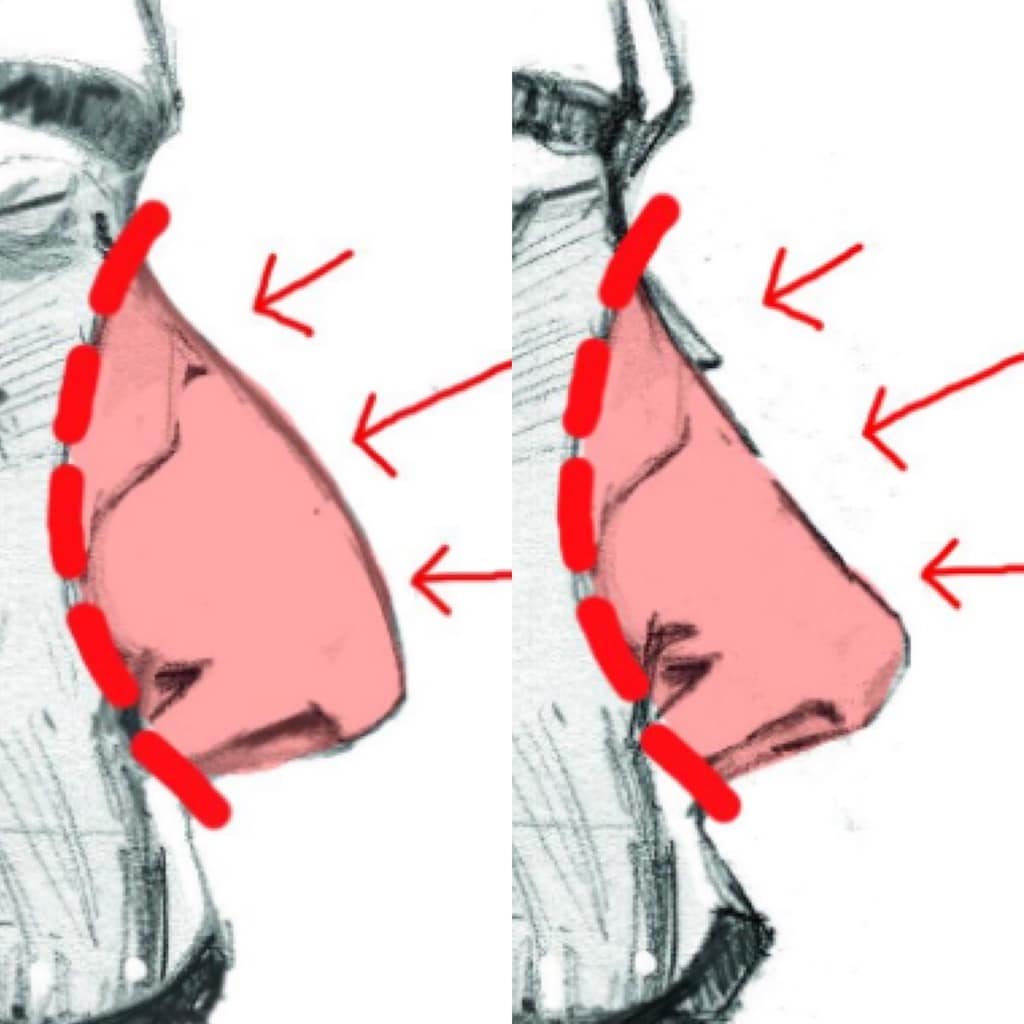 Preservation Rhinoplasty : rhinoplastie en préservation - Rhinoplastie ...